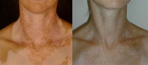 Protopic On Lips Vitiligo