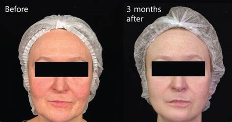 Xtherma High Frequency Rf And Cryogen Solunis Medical Shaping The