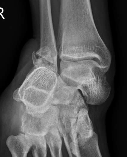 Subtalar Dislocation The Bone School