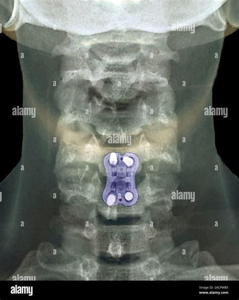 Neck Arthritis Treatment Coloured X Ray Of The Neck Of A 48 Year Old