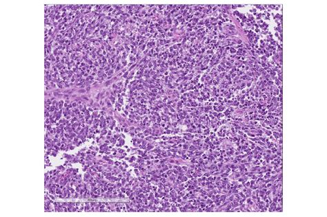 Undifferentiated Round Cell Sarcoma Of Infancy This Highly Cellular Download Scientific