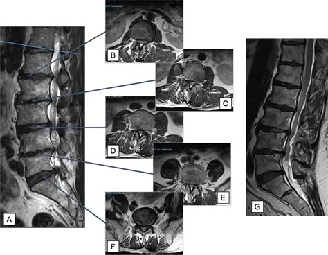 Case Example Of Multilevel Segmental Lumbar Spinal Stenosis Note The