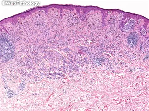Melanoma Breslow Thickness