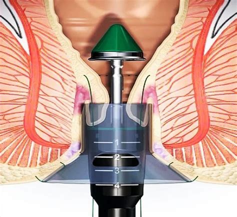 Mpph34 Miph Mirus Hemorrhoids Stapler Disposable Circular Stapler At ₹ 8010 Piece In Gurugram