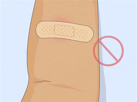 How To Properly Place A Tb Skin Test With Pictures Wikihow