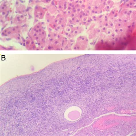 Calcification Foci Stain With H E Download Scientific Diagram