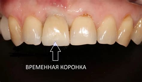 Временные коронки как важный этап имплантации - Немецкий ...