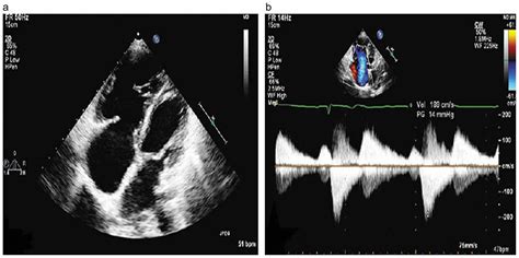 Carcinoid Heart Disease Structural Heart