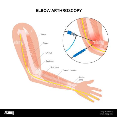 Illustration Of Elbow Arthroscopy Surgery This Is A Procedure For Diagnosing And Treating Joint