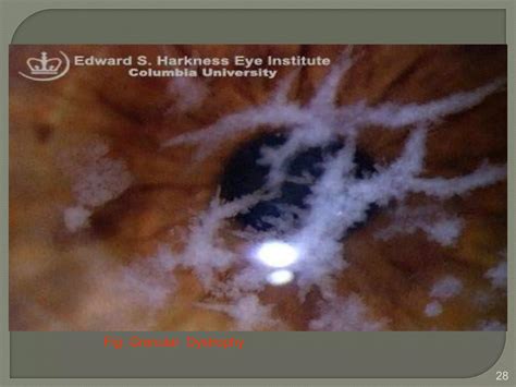 Corneal Degeneration And Dystrophies Pptx