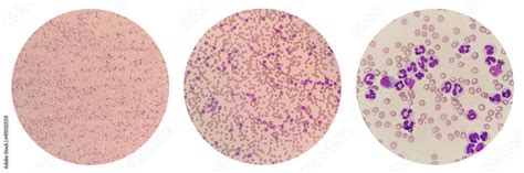 Leukemoid Reaction Describes An Increased White Blood Cell Count Or