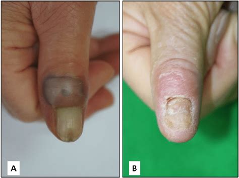 A A Painful Grayish 08×06 Inch Sized 20×15 Cm Abscess On Her