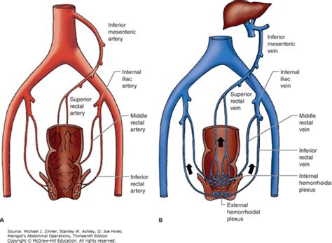 Cancer Of The Rectum Abdominal Key