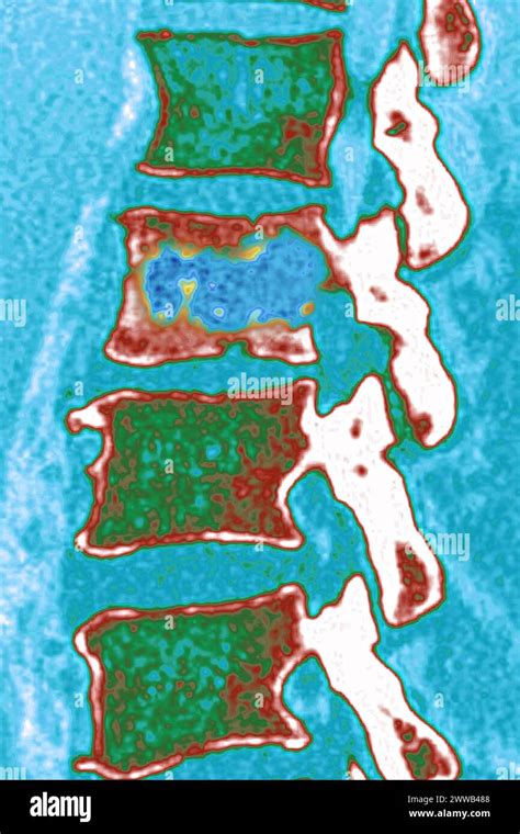Vertebral Osteitis Inflammation Of The Bone Tissue Of A Lumbar