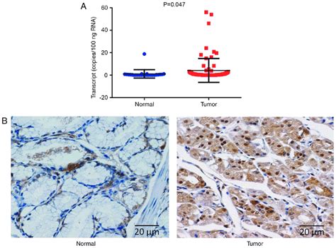 A Expression Of Adam29 In Tumor And Paracancerous Tissues Of Patients Download Scientific