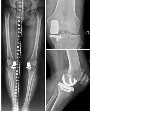 Postoperative Scannogram Of The Bilateral Lower Limb And Anterior