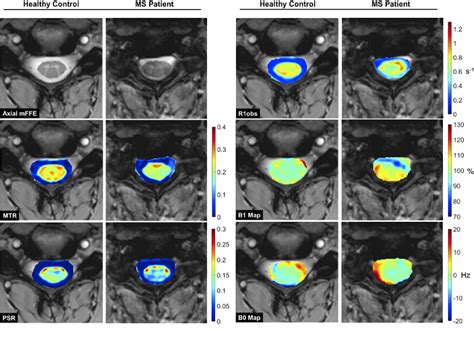 Figure 2 From Detecting Macromolecular Differences Of The Csf In Low