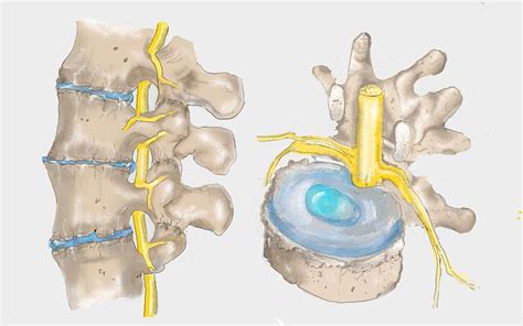 Osteochondrose Behandlung And Prognose