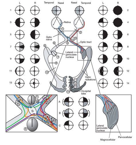 Visual Field Lesions Optometry Optometry Education Anatomy And Visual Field Lesions Optometry Optometry Education Anatomy And