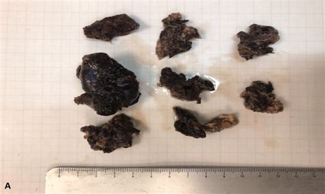 Macroscopic Appearance Of The Tumor After Fixation On 10 Buffered Download Scientific Diagram