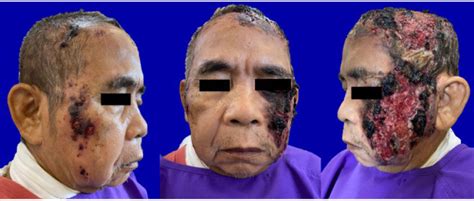 Angiosarcoma Photodynamic Therapy Activated Immune Response Against