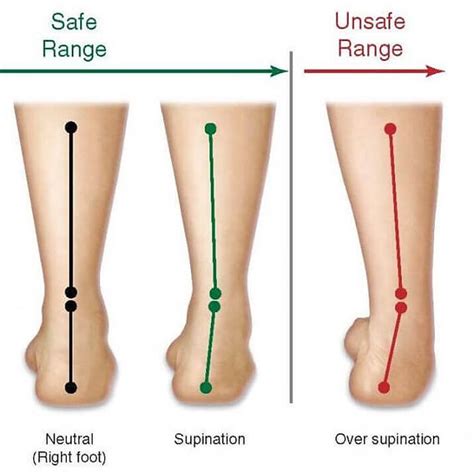 Supination Of Foot Orthotics Arch Support Shoes Insoles Inserts For