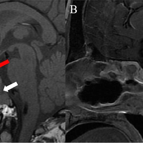 Postoperative Pituitary Mri Postoperative Pre A And Post Contrast