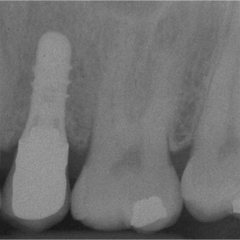 Application Of Perisolv In The Peri Implant Sulcus Download