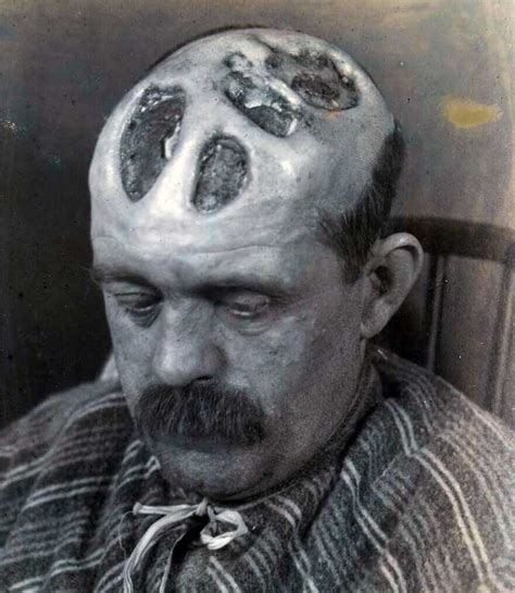 Pictures Syphilis All Stages Warning Strong Images