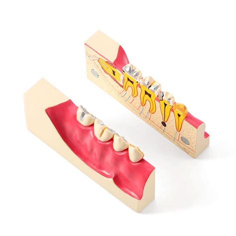 Dental Implant Teeth Model Demonstration Overdenture Restoration 4 Low