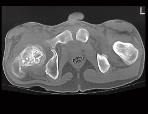 Chondroblastoma Of The Femur Oncosurgery