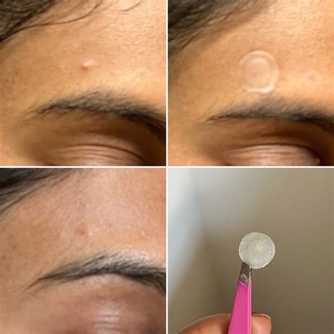 Good Molecules Pimple Patch Review With Photos PS Beauty