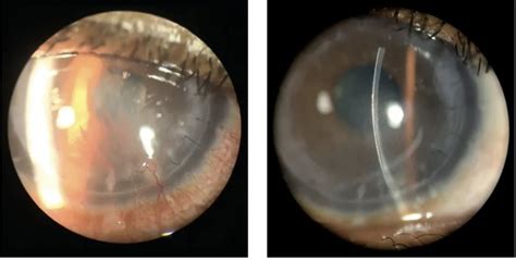 Corneal Neovascularization