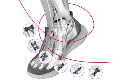 Fda Clears Depuy Synthes Trileap Plating System