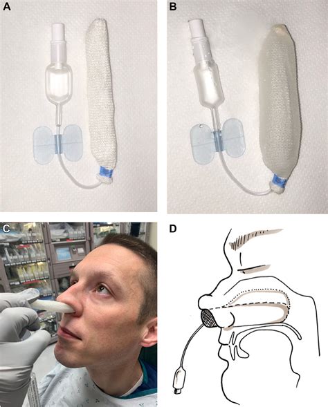 Managing Epistaxis Annals Of Emergency Medicine