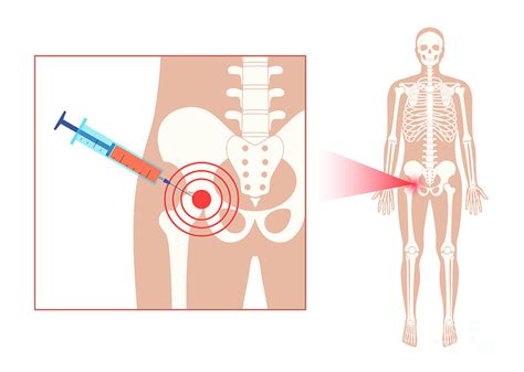 Hip Joint Injection Photograph By Pikovit Science Photo Library Fine Art America