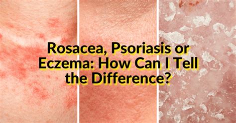 Psoriasis Vs Rosacea Differences Treatment And Other Conditions