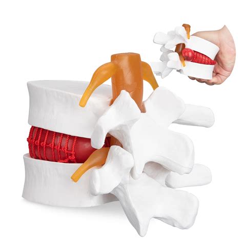Bcenyaz Disc Herniation Model Human Lumbar Disc Herniation Spine Model