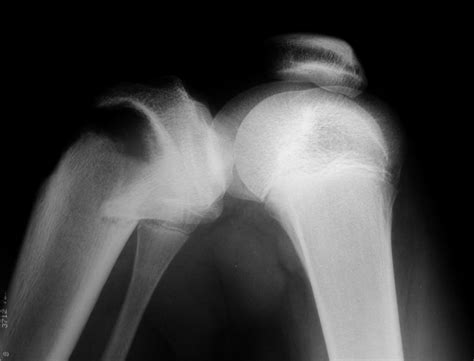 Definite Swelling Of The Upper Outline Of The Tibia Figure 2 The Definite Swelling Of The Upper Outline Of The Tibia Figure 2 The