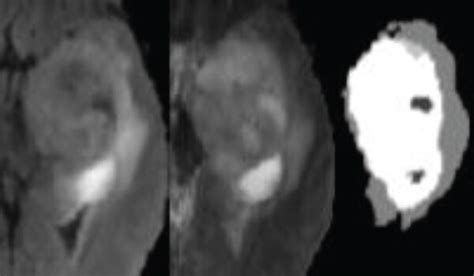 Multimodal Mri Brain Tumor Image Segmentation Using Sparse Subspace Clustering Algorithm Liu