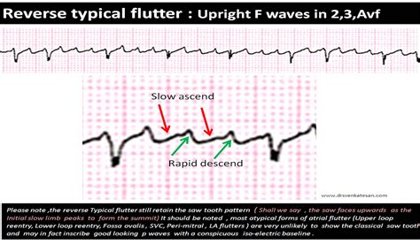 Atrial Flutter Sawtooth Ecg