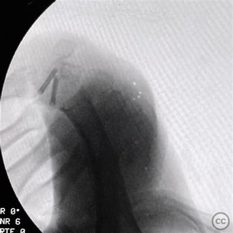 Hamate Fracture Plus 4th 5th Carpometacarpal Dislocations