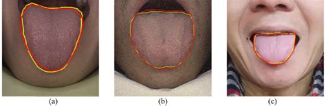 The Segmentation Result Of The Tongue Image Where The Golden Contours