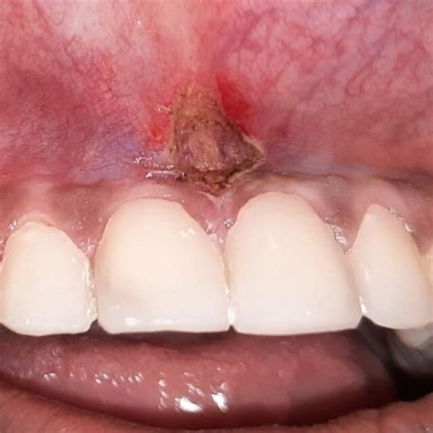 Frenectomy Done With Laser And Temporary Veneers Placed Download Scientific Diagram