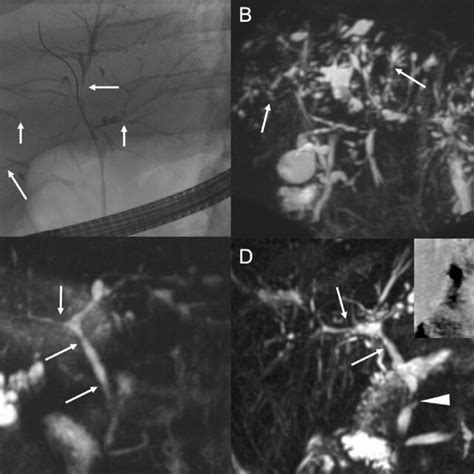 Typical Imaging Findings On ERCP And MRCP In Different Patients With Download Scientific