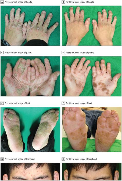 Jama Dermatology On Linkedin Generalized Verrucosis And 3c