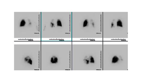 A A Planar V Q Scan With Multiple Perfusion Defects On The Left Download Scientific Diagram