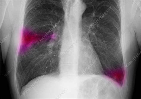 What Is Chest X Ray Infiltrate At Christian Brown Blog
