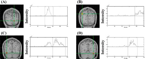 Figure 1 From Hierarchical Multiscale Bayesian Algorithm For Robust Megeeg Source