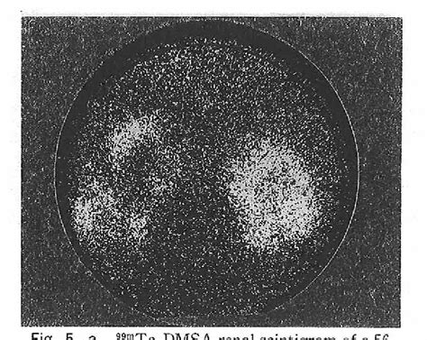 Figure 5 From 99mtc Dimercaptosuccinic Acid Dmsa Renal Scintigraphy